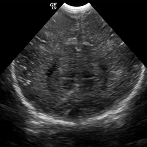 WIDI - Neonatal Head Ultrasound 3
