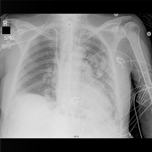 WIDI - AP Portable Chest 2