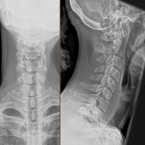 WIDI - Cervical Spine Plain Film 2
